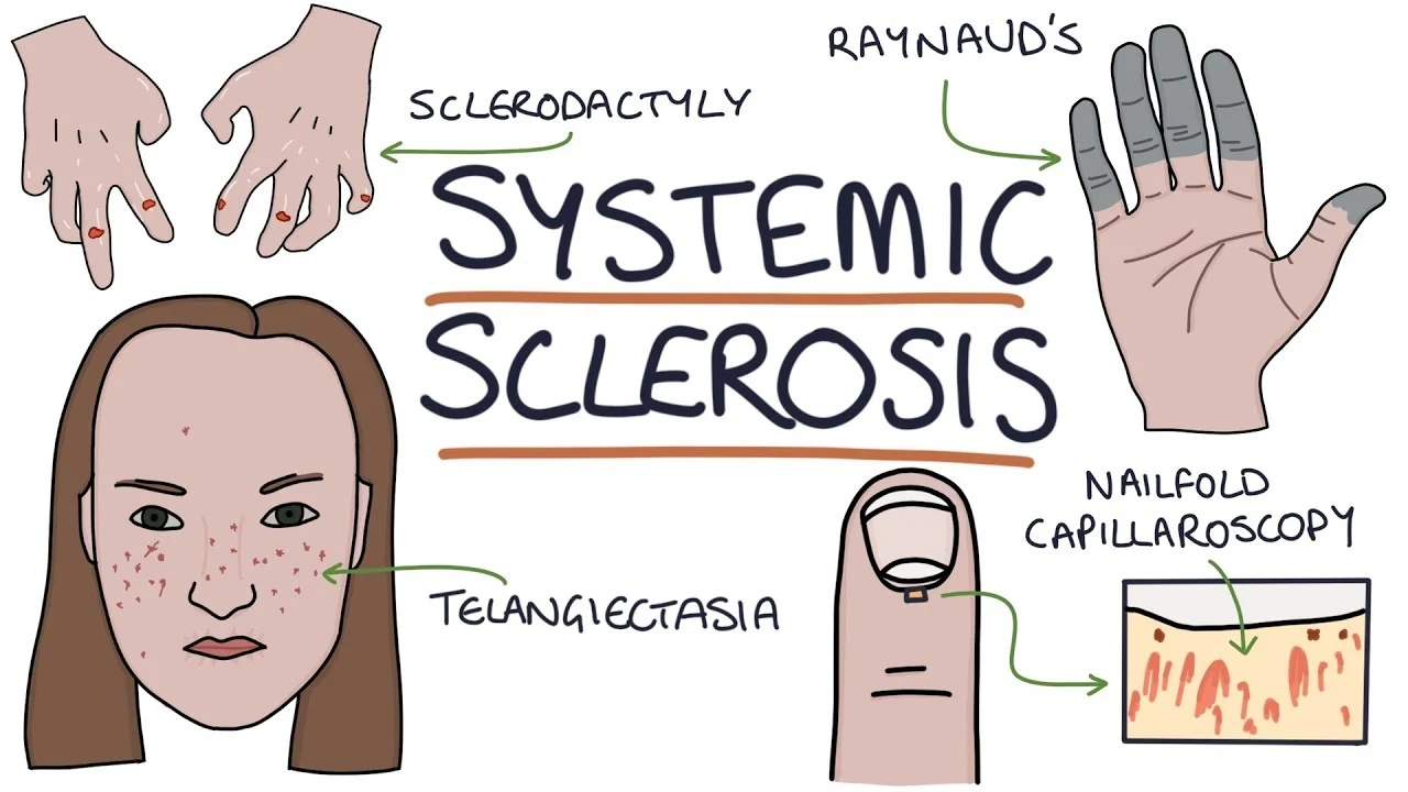 What Treatments are Available for Patients with Systemic Sclerosis? - BioXcellerator